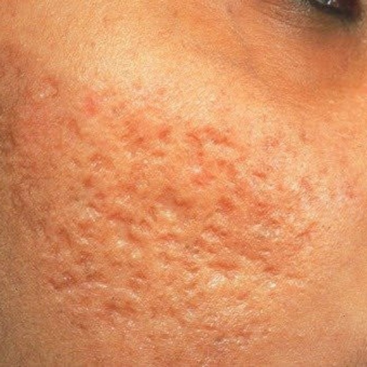 PARA SA FACE NA BUTAS BUTAS/ PIMPLES MAY ALAM AKONG PAMPAKINIS JAN.. PM ME